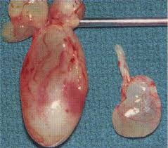 Polip Hidung – Jadwal Praktek Biaya Operasi Amandel Sinusitis