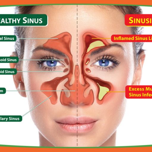 Sinusitis Kronik – Jadwal Praktek Biaya Operasi Amandel Sinusitis